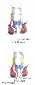 Hämorrhoiden - EDZ Hessen Mitte